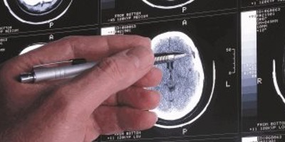 A New Day in Alzheimer’s Research & Treatment: What’s Next in the Pipeline?